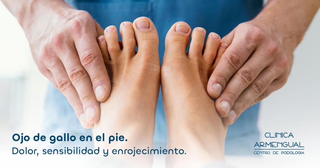 Ojo de Gallo en el Pie | Clínica Armengual