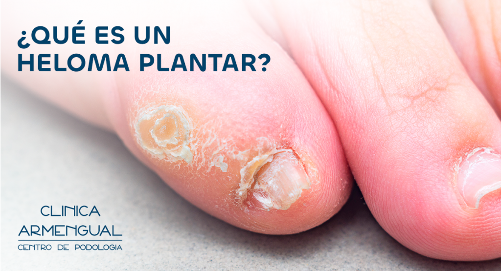 Heloma Plantar: Qué es y cómo tratarlo | Clínica Armengual