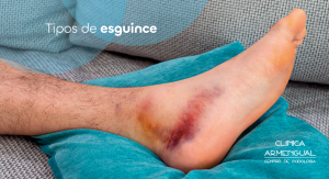 Tipos de esguinces de tobillo | Clínica Armengual