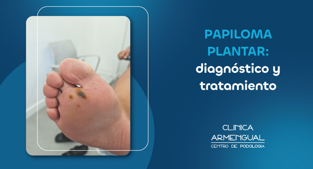 Papiloma del Pie: Diagnóstico y Tratamiento | Clínica Armengual