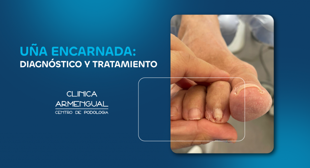 Uña encarnada: Diagnóstico y tratamiento | Clínica Armengual