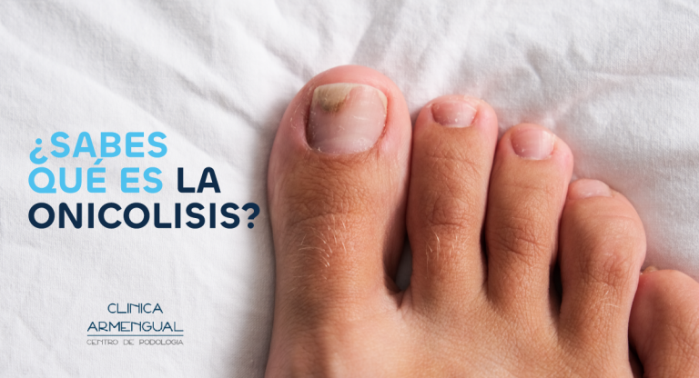 Onicolisis: Qué es, Causas y Tratamiento | Clínica Armengual