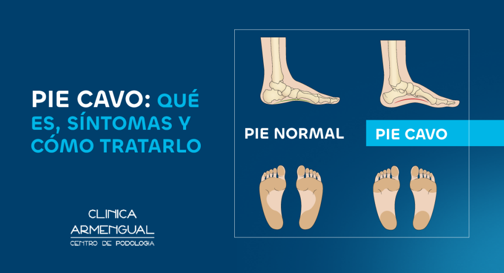 ¿Qué es el Pie Cavo? Síntomas y Ejercicios | Clínica Armengual