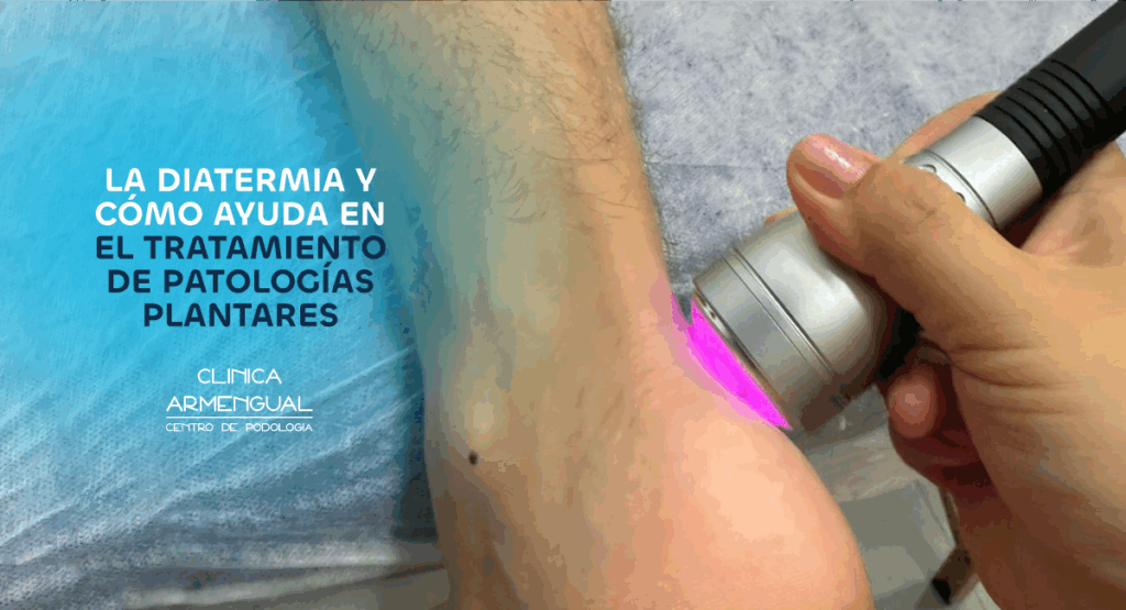 ¿Qué es la Diatermia y para Qué Sirve? | Clínica Armengual