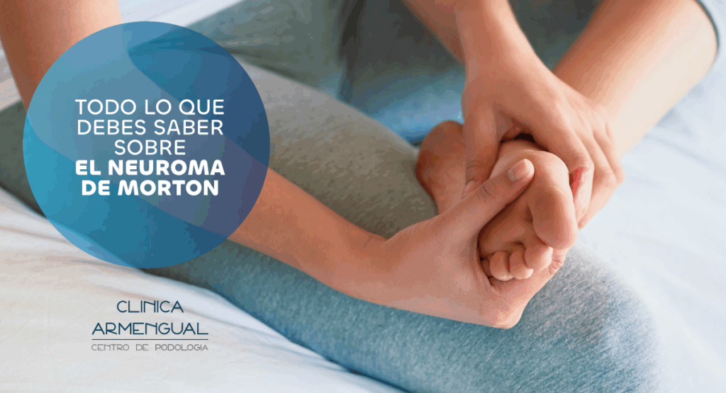 Neuroma de Morton: Síntomas y Tratamientos | Clínica Armengual